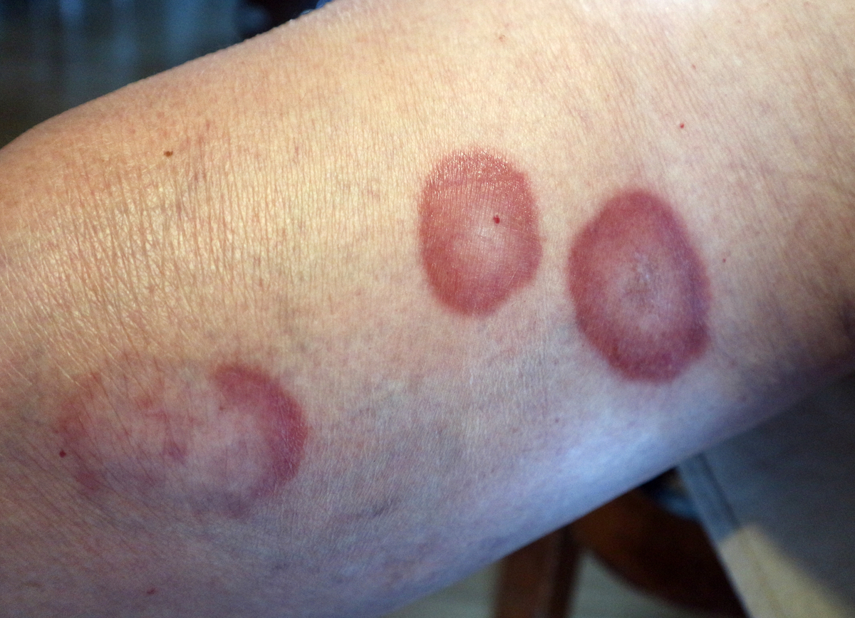 Granulome annulaire, symptômes, causes et traitements