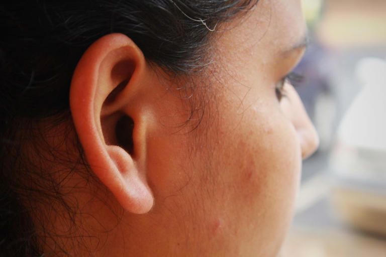 What experts want you to know about Ozempic earlobes