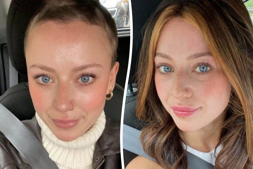 Woman, 23, has to wear wigs after ‘work stress’ caused hair to fall out