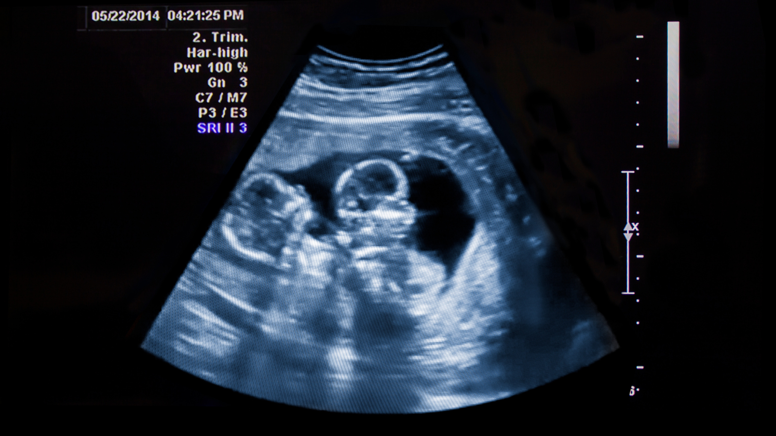 Twin-to-Twin Transfusion Syndrome (TTTS): What It Is and How It Happens