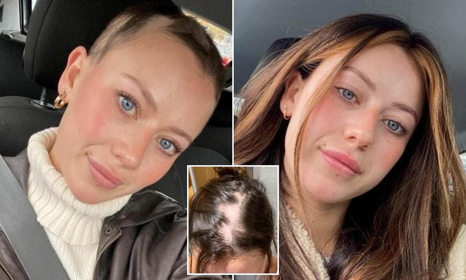 Young woman left bald after work stress triggered incurable hair loss ...