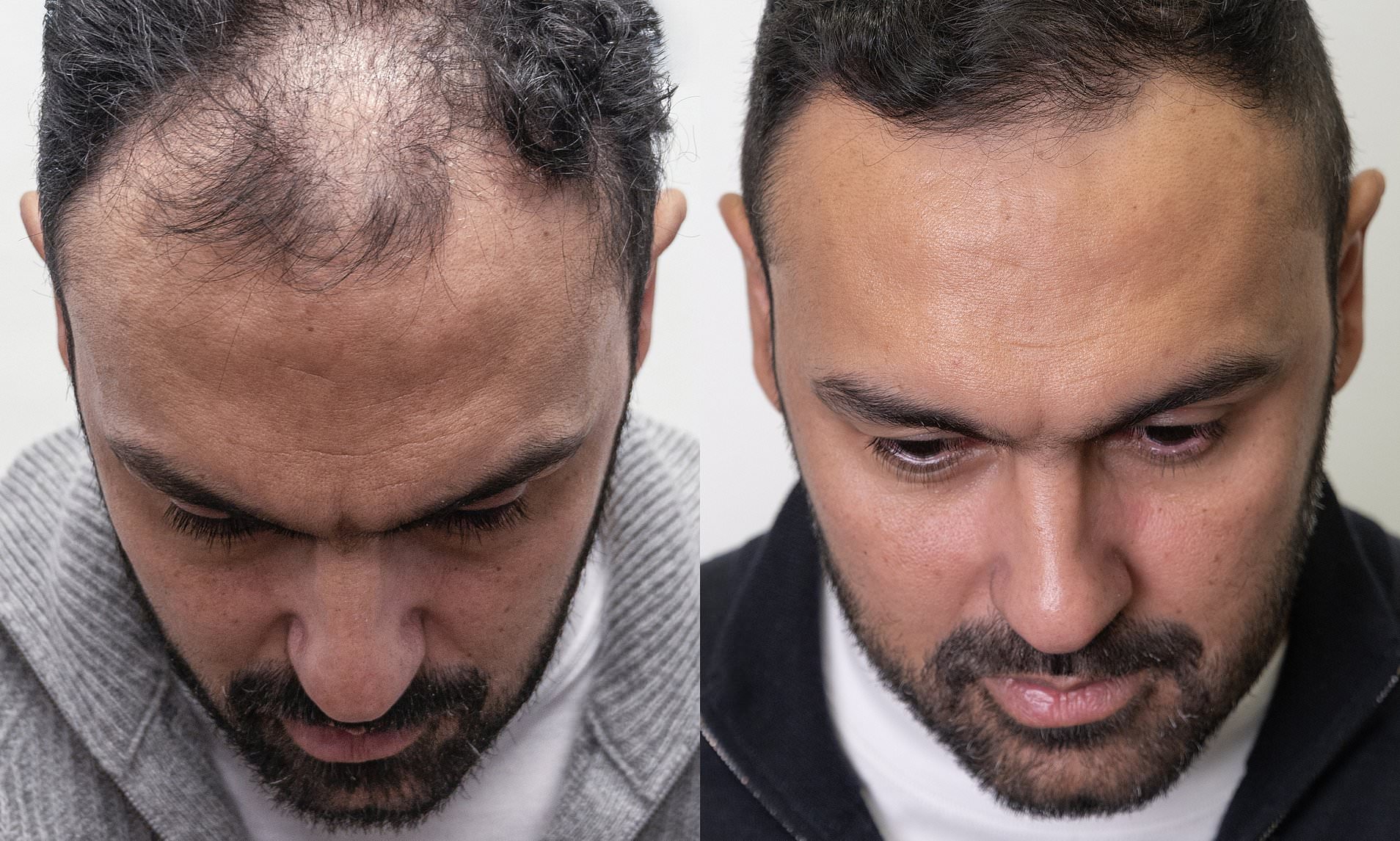 Ex-Aston Villa star shows off incredible hair transplant results - 'I ...