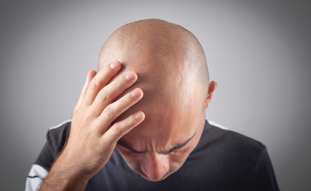 Male Pattern Baldness: How To Spot It Early And What You Can Do