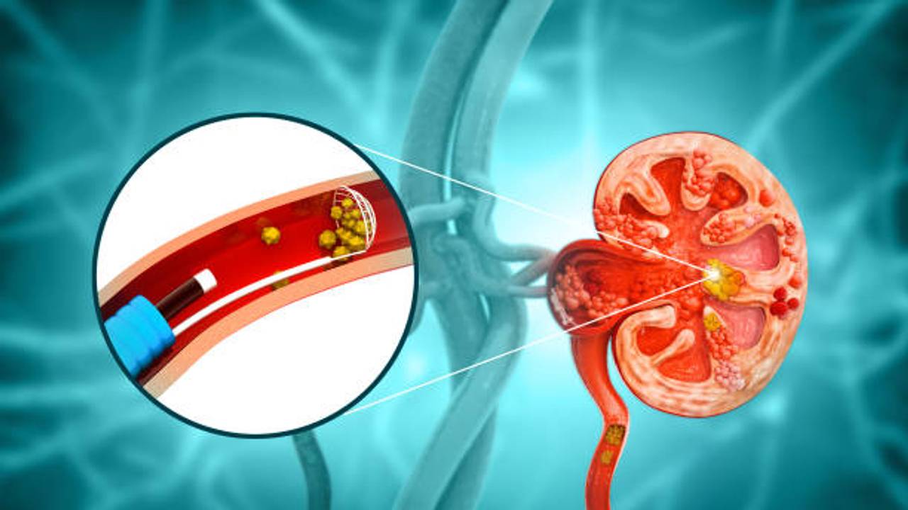 Kidney Stone Alert! Remove These Foods from Your Plate Today, Say Doctors