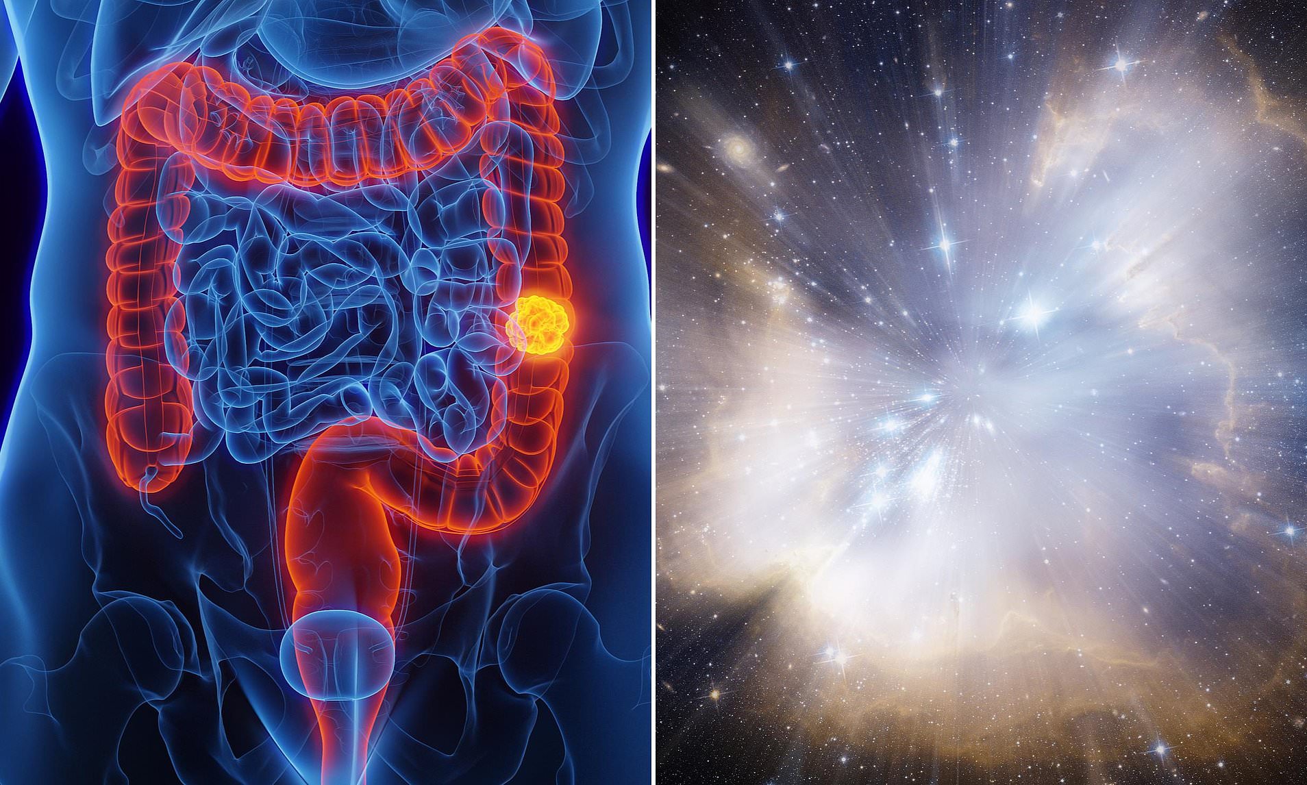 Scientists pinpoint bowel cancer's 'Big Bang' moment - it could ...