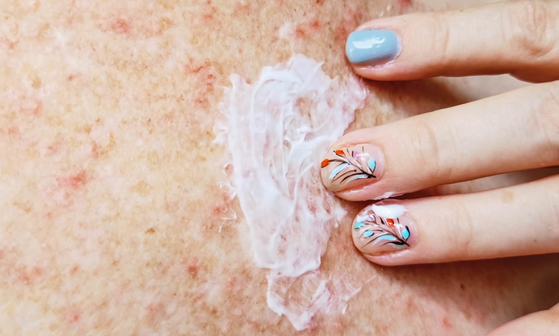 NHS approves revolutionary new treatment for debilitating skin ...