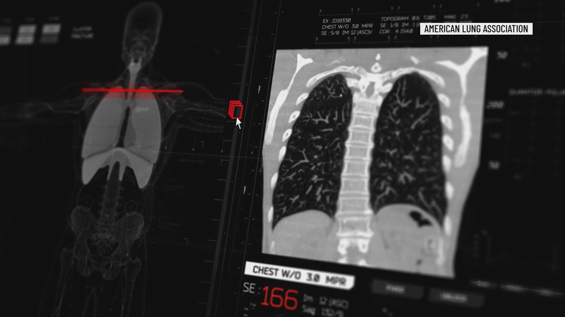 American Lung Association ‘State of Lung Cancer’ report released