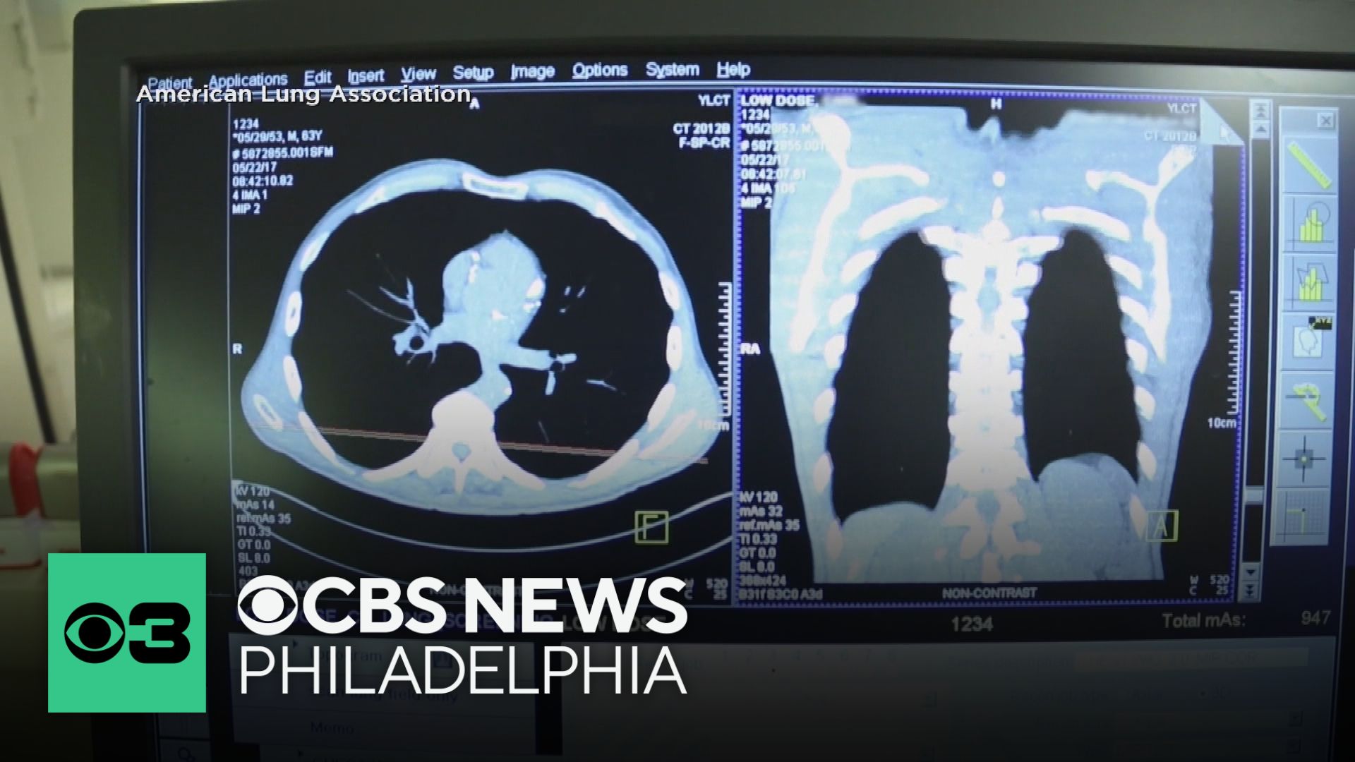 New study shows progress being made in fight against lung cancer