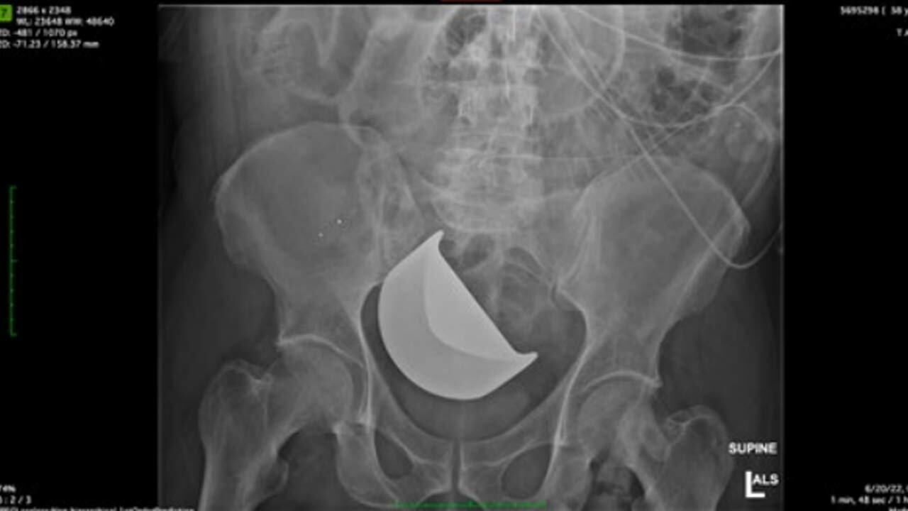 State pays $1 million after man dies from MUSC blade left in body