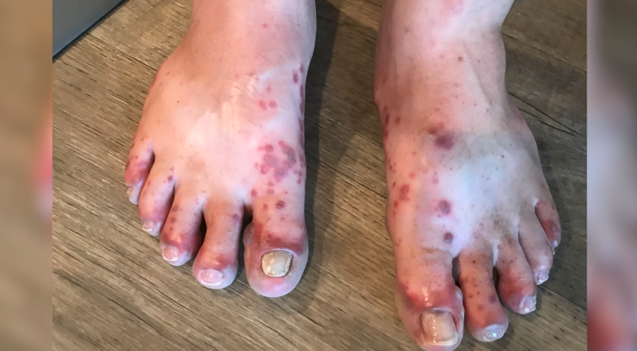 Hand, foot and mouth disease cases on the rise in Mobile