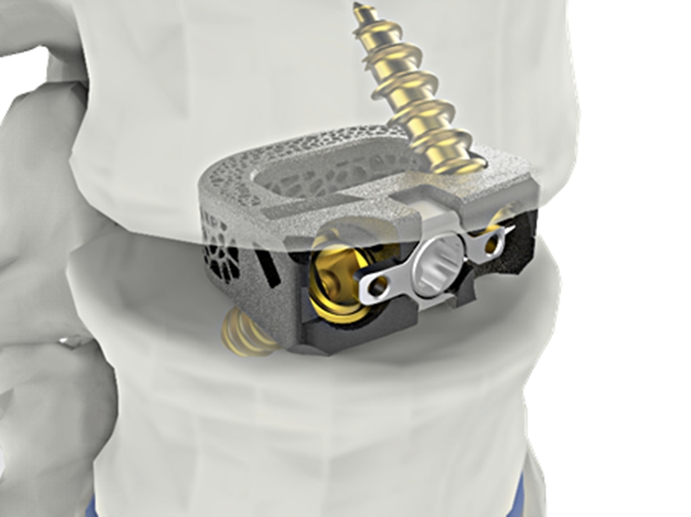 시지메드텍, 척추 임플란트 '유니스페이스' FDA 승인
