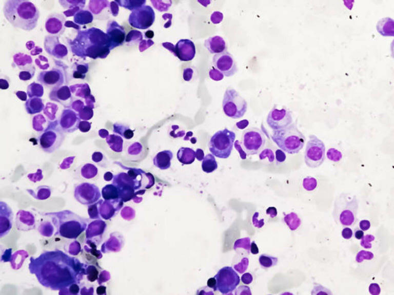 J&J's Tecvayli shows promise as a second-line multiple myeloma treatment