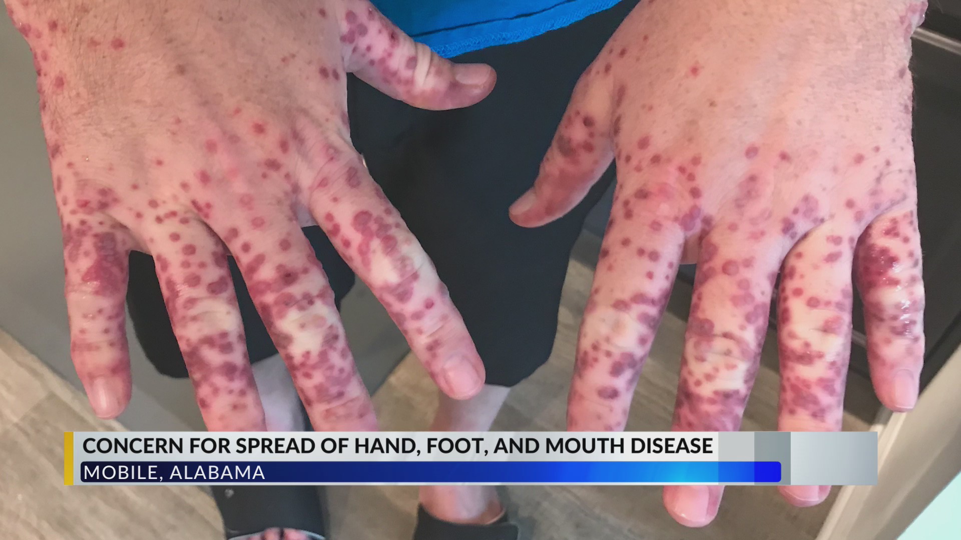 Hand, foot and mouth disease cases on the rise in Mobile