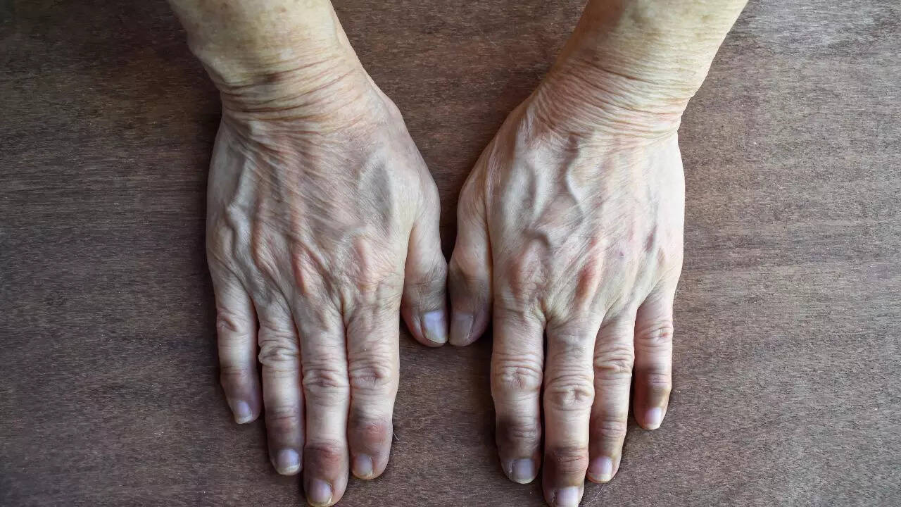 Why your hands or fingers turn blue: Understanding peripheral cyanosis ...
