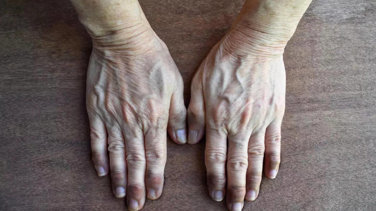 Why your hands or fingers turn blue: Understanding peripheral cyanosis ...