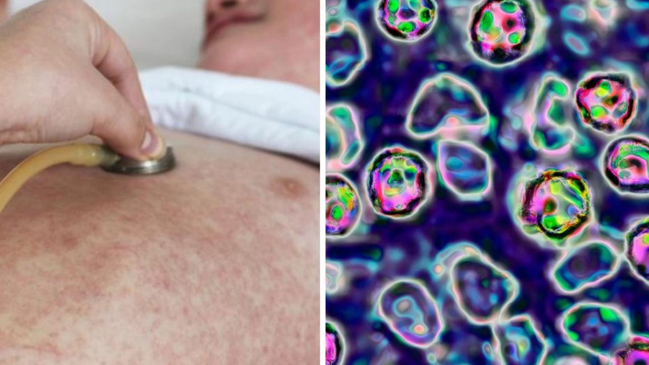 Warning as deadly disease outbreak grows