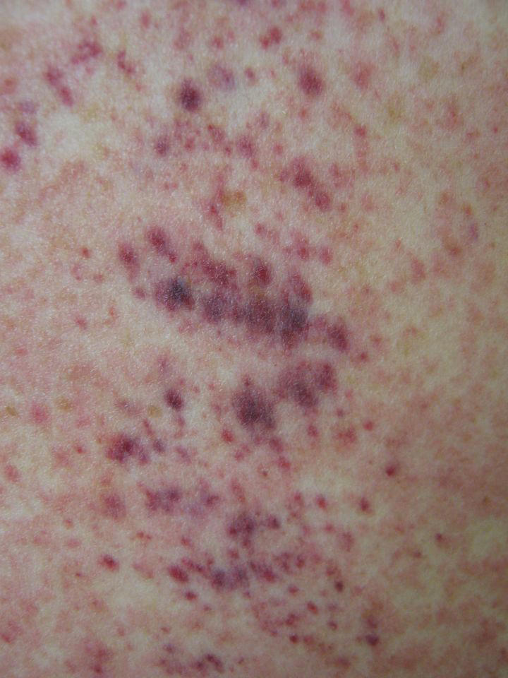 What Are Petechiae? Causes of Red Blood Spots on Your Skin