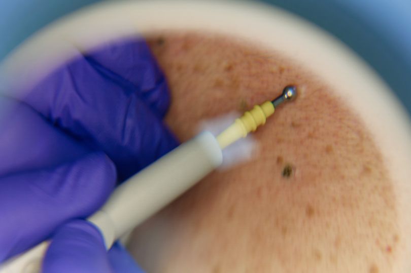 New wearable patch detecting one type of cancer could save thousands of ...