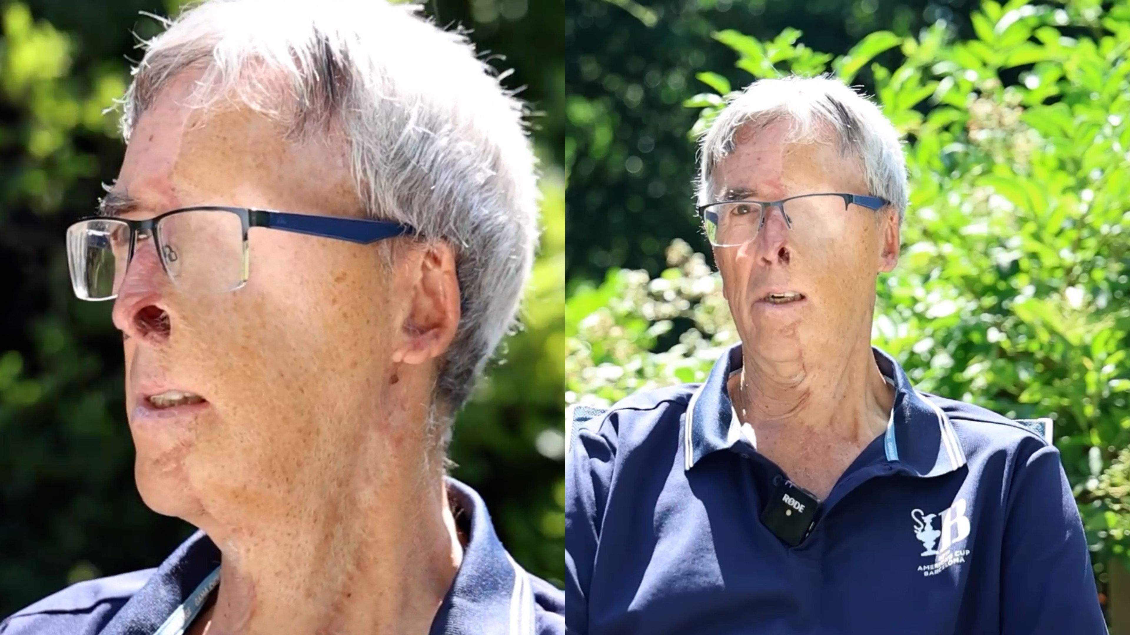 Injured cyclist gets new 3D printed face