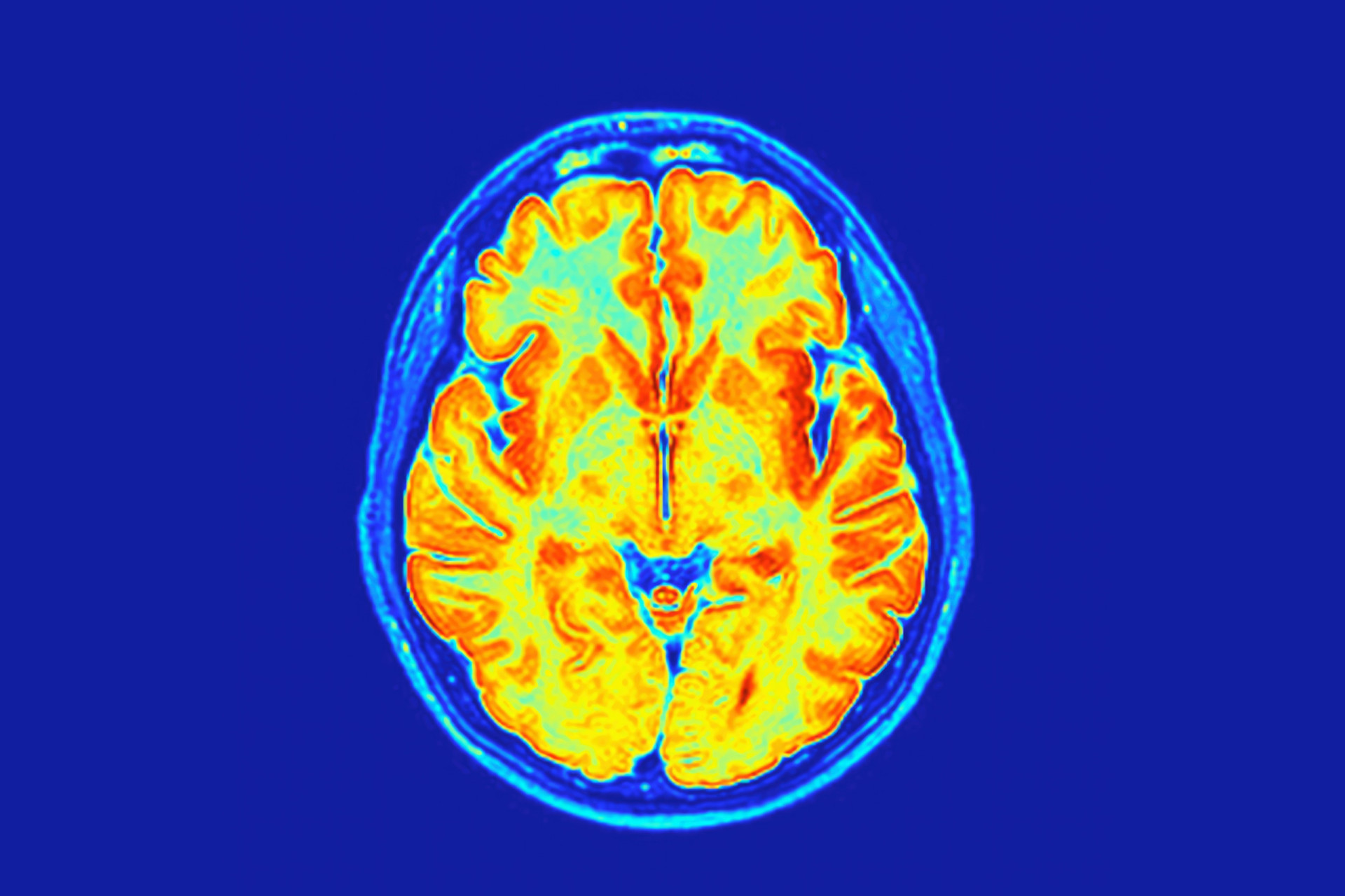 Il litio potrebbe curare il morbo di Alzheimer?