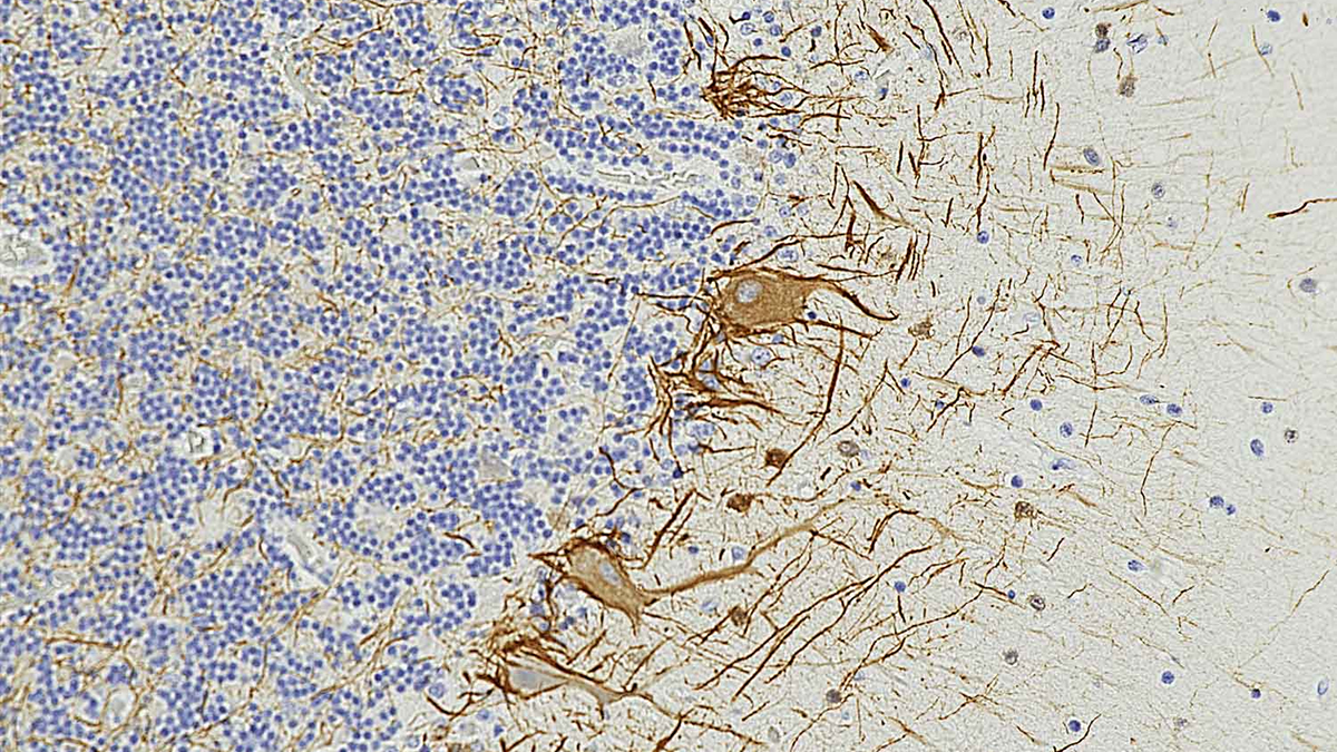 Blood Signals May Predict Multiple Sclerosis 7 Years Before Symptoms