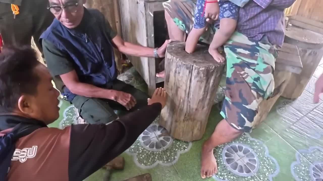 Toddler with leg trapped in log is rescued with a chainsaw