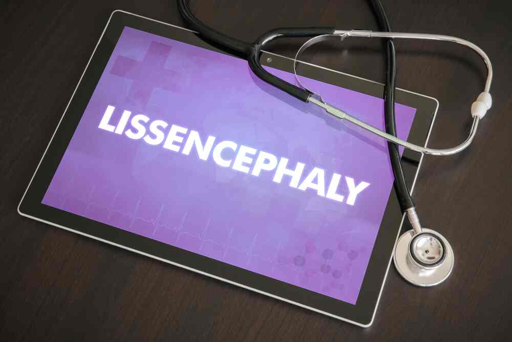 Lissencephaly: Types, Causes, Symptoms, and Diagnosis