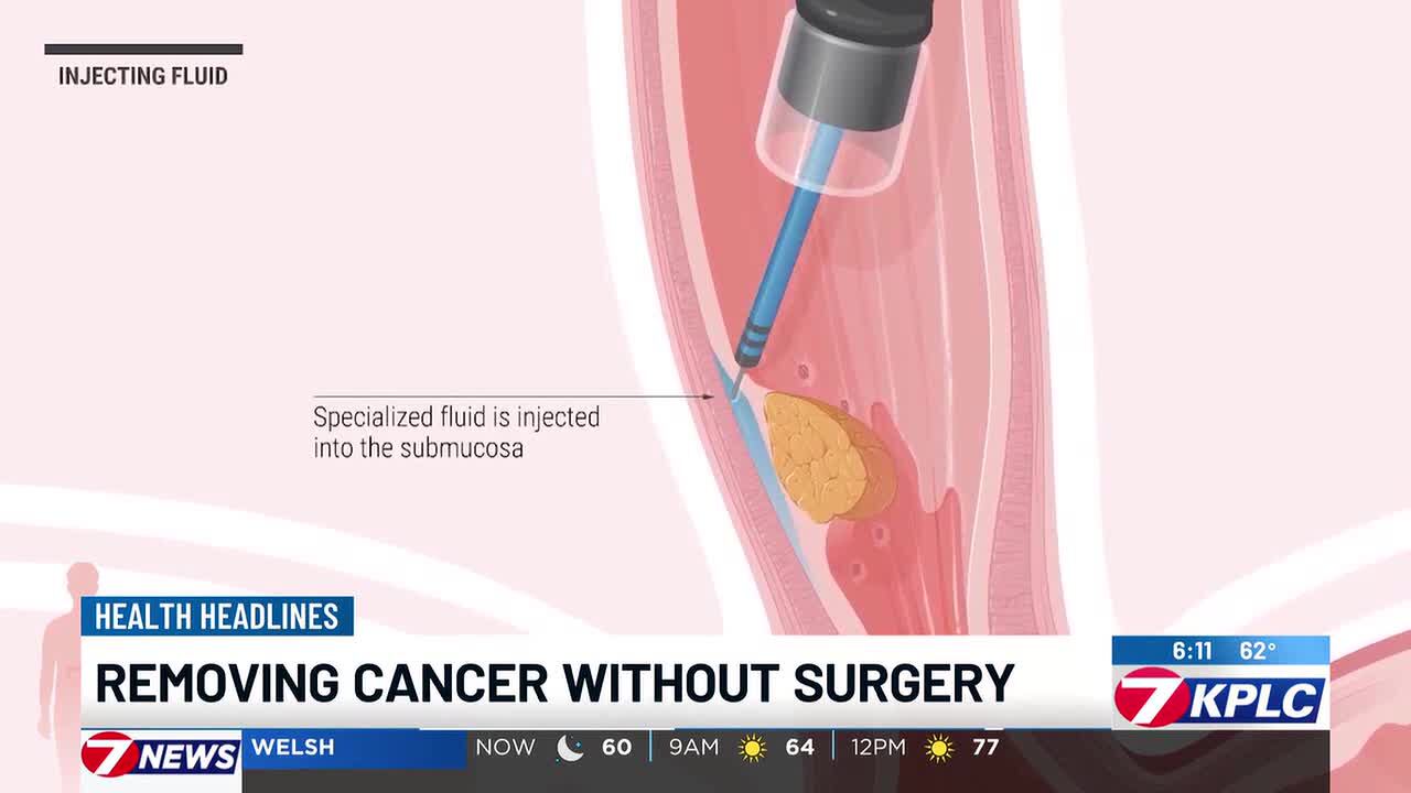 Removing cancer without surgery