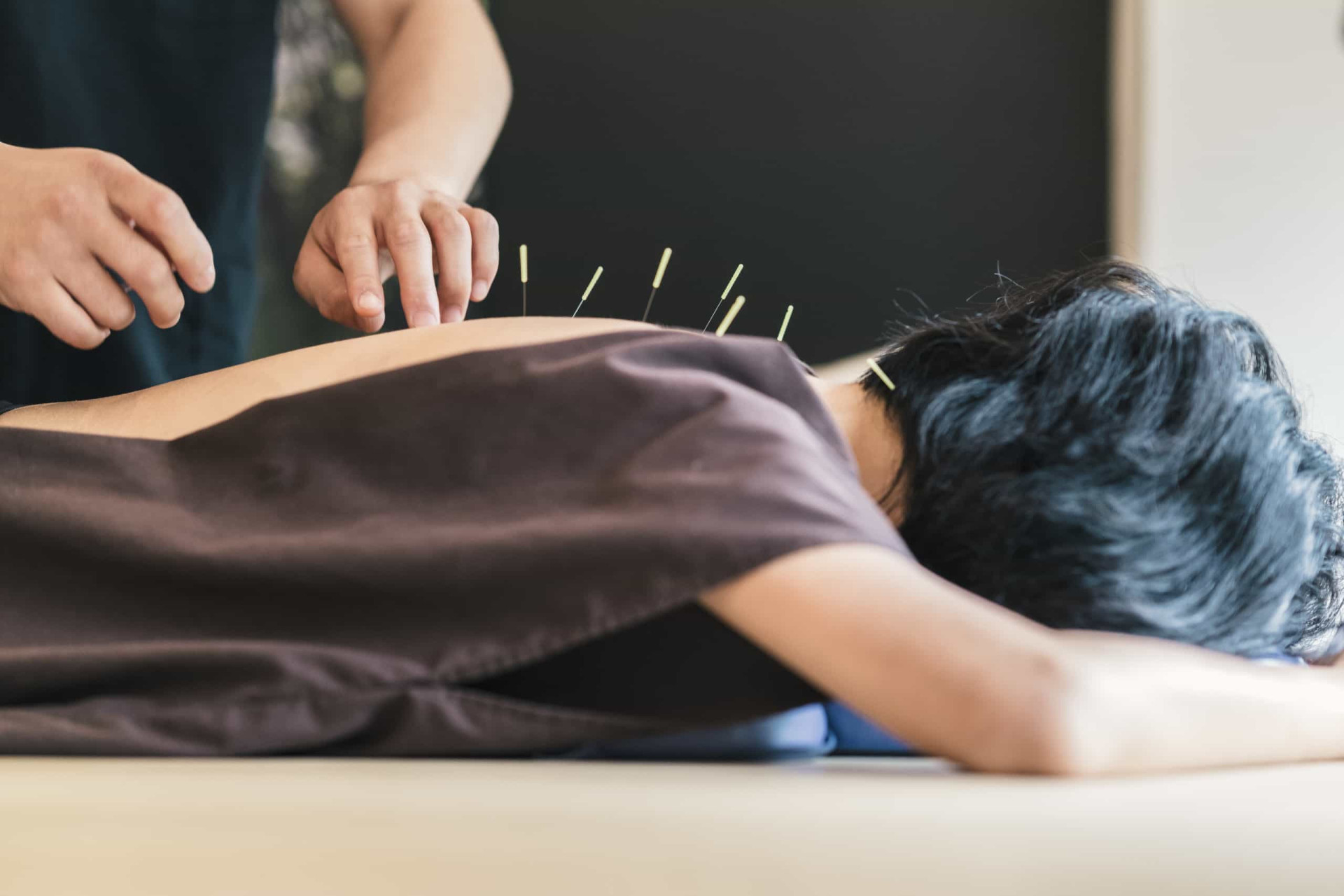 How acupuncture is changing modern medicine