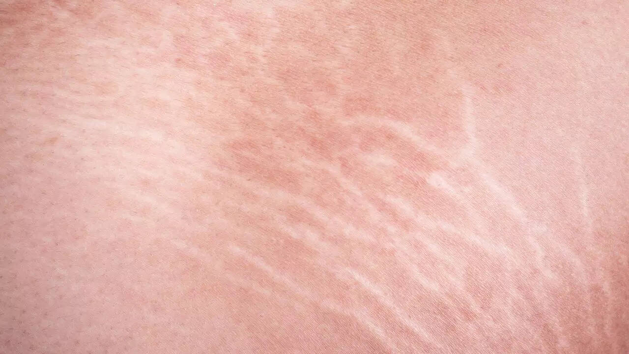 6 Effective tips to prevent stretch marks and improve skin elasticity