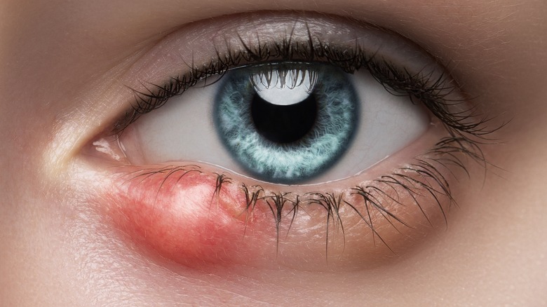 What It Means If You Wake Up With One Eye Glued Shut