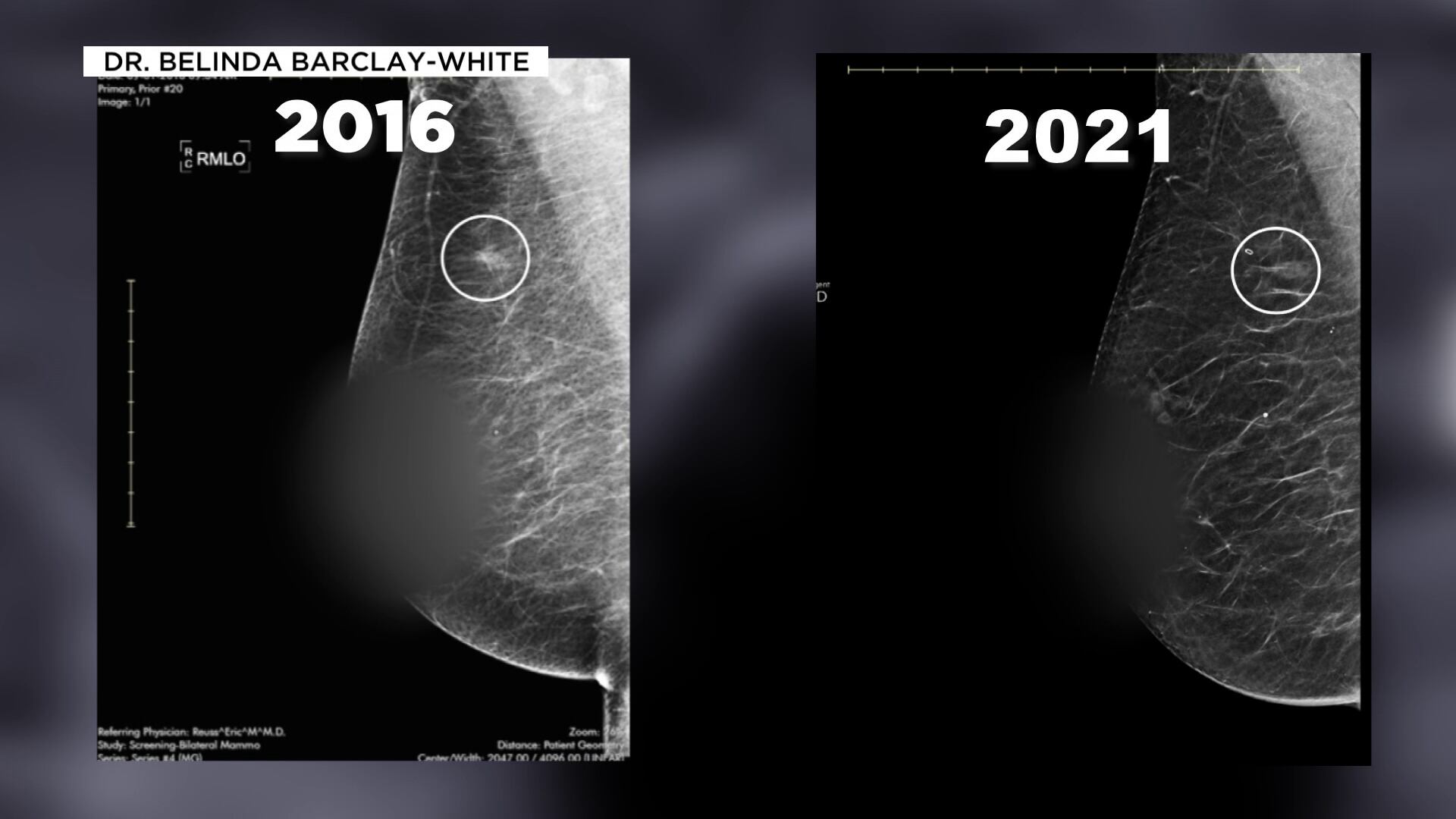 ‘Life-changing’ minimally invasive breast cancer treatment gets FDA ...
