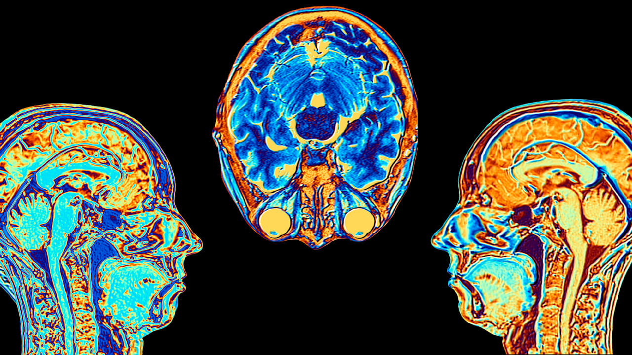 „Brain Age Gap“ - Wenn das Gehirn vorschnell altert – und was dagegen hilft