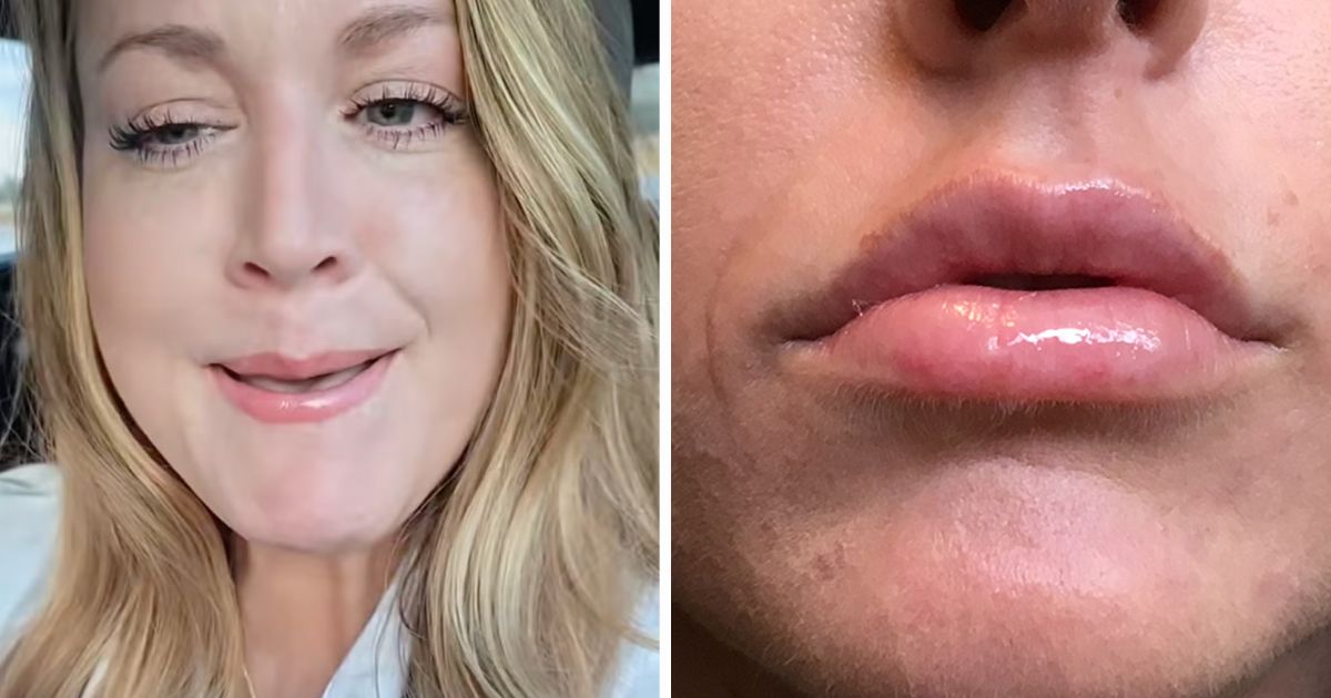Lip Flip Fail! Woman Says Botox Left Her Unable to Sip Coffee or Say ‘P’