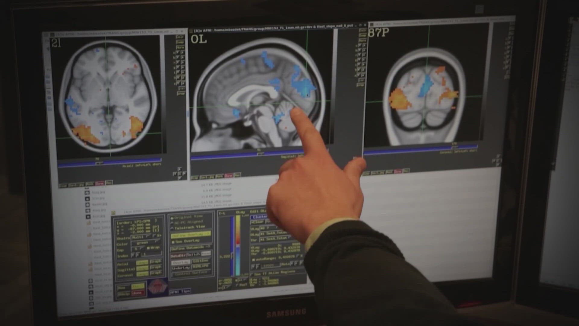 Veterans battling PTSD with psychedelics