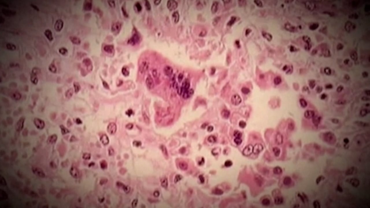 Measles exposure flagged at Montreal Children’s Hospital ER