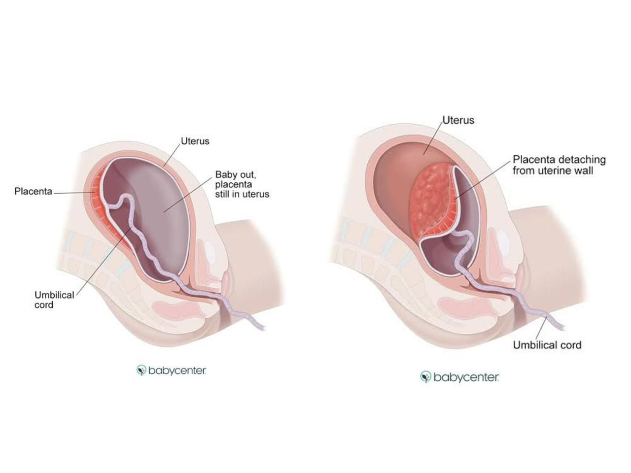 Viral Fenomena "Rahim Copot" di Tiktok, Begini Penjelasan Secara Medis