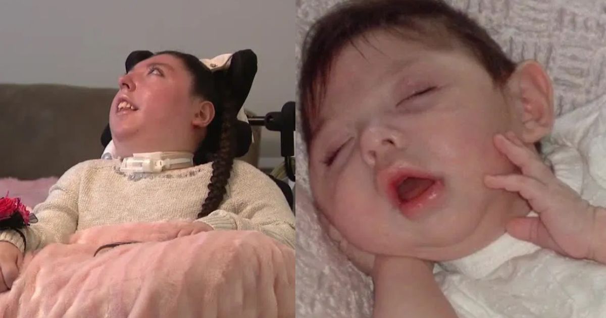 Born With Almost No Brain, ‘Miracle Baby’ Alex Survives 20 Years – Family Says The Key To This ...