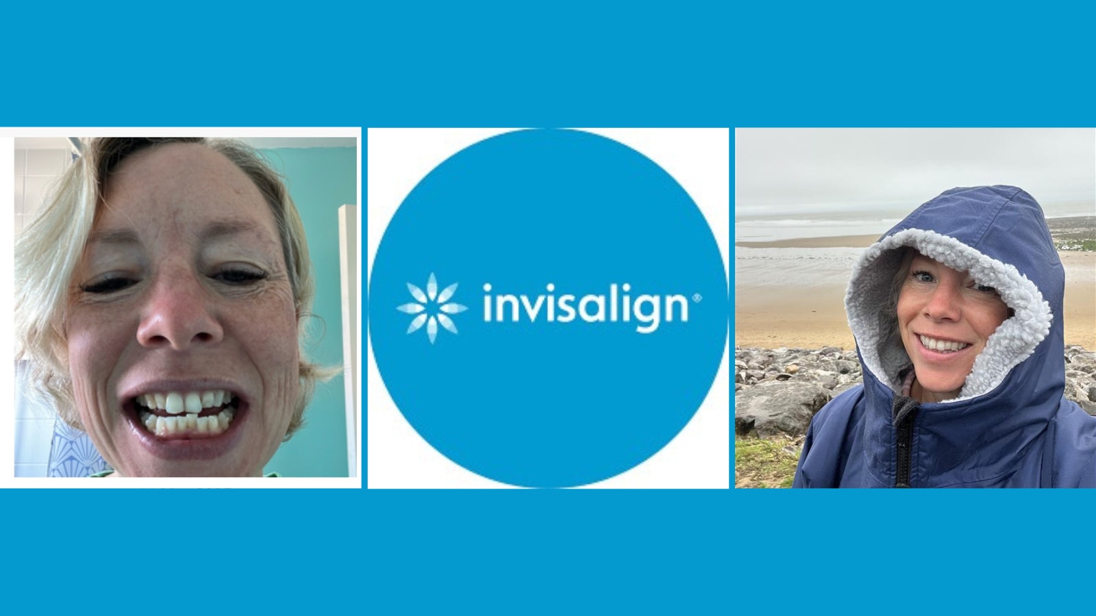 Invisalign review: How I got the smile I’ve always wanted