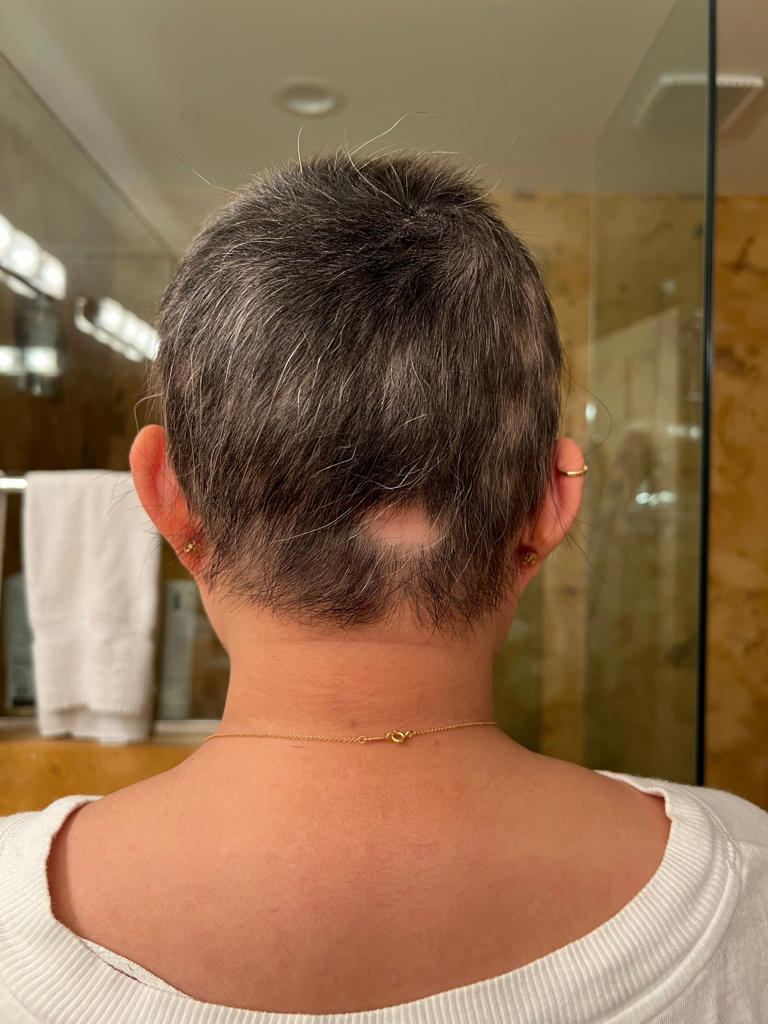 18 Million People Watched My Hair Grow Back After I Went Bald