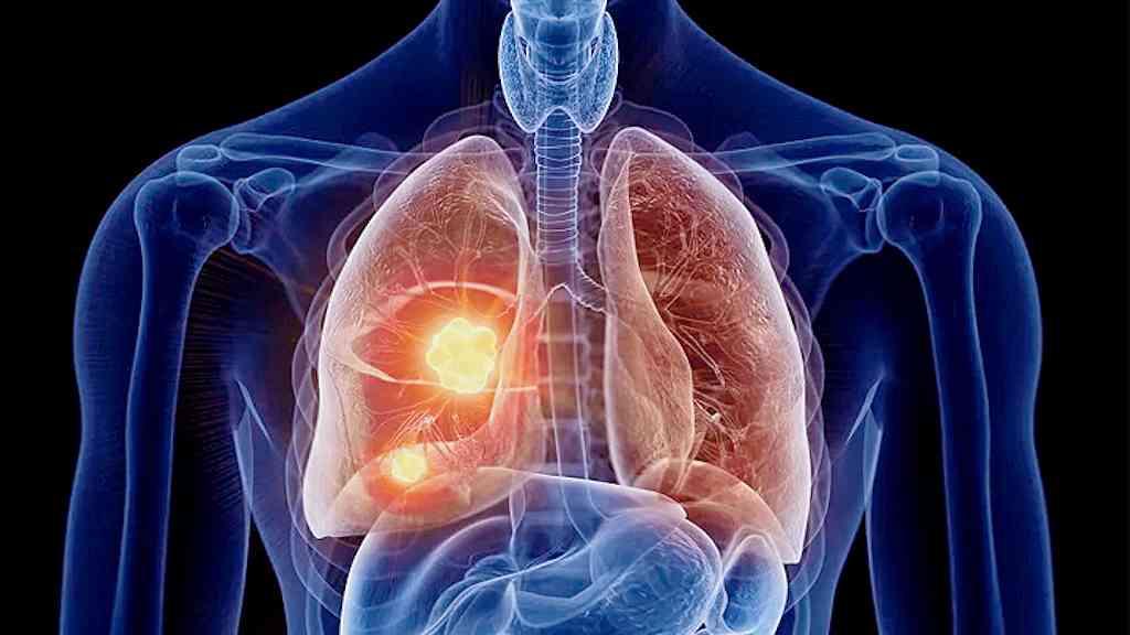 Câncer de pulmão segue como o mais letal, com baixa taxa de sobrevivência