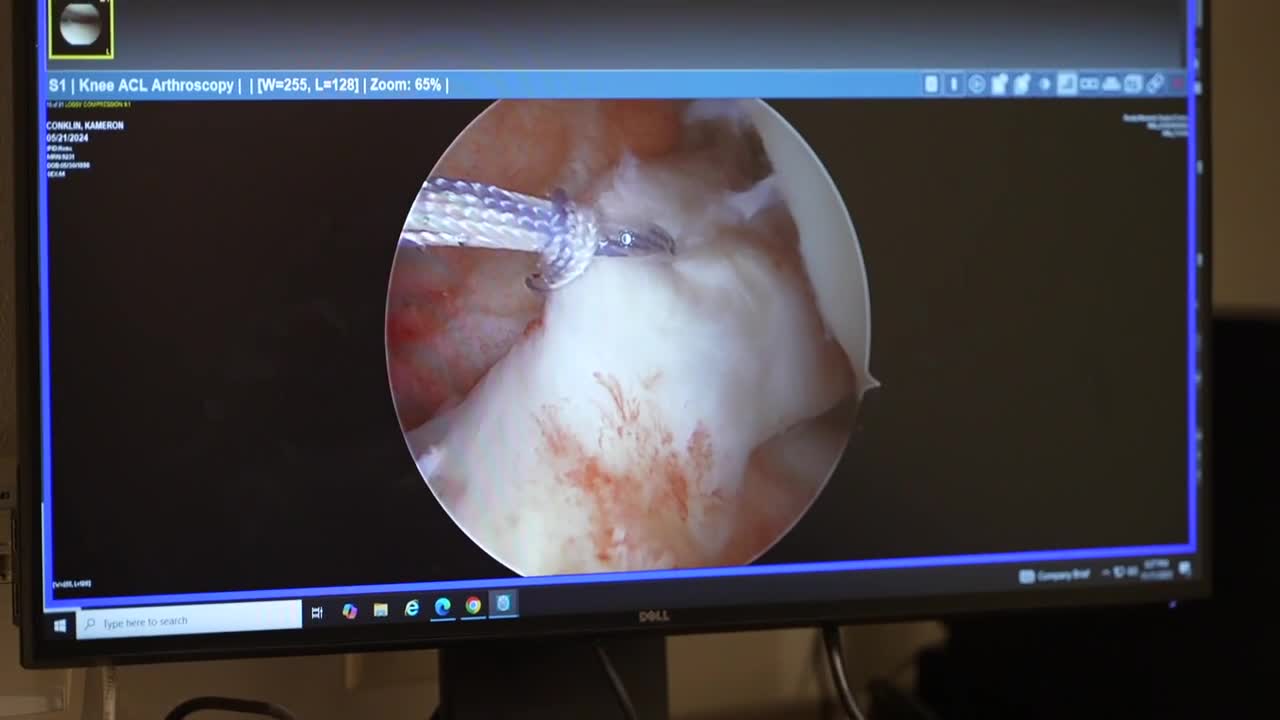 Revolutionary ACL Surgery Gets Montana Snowboarder Back on Slopes in ...