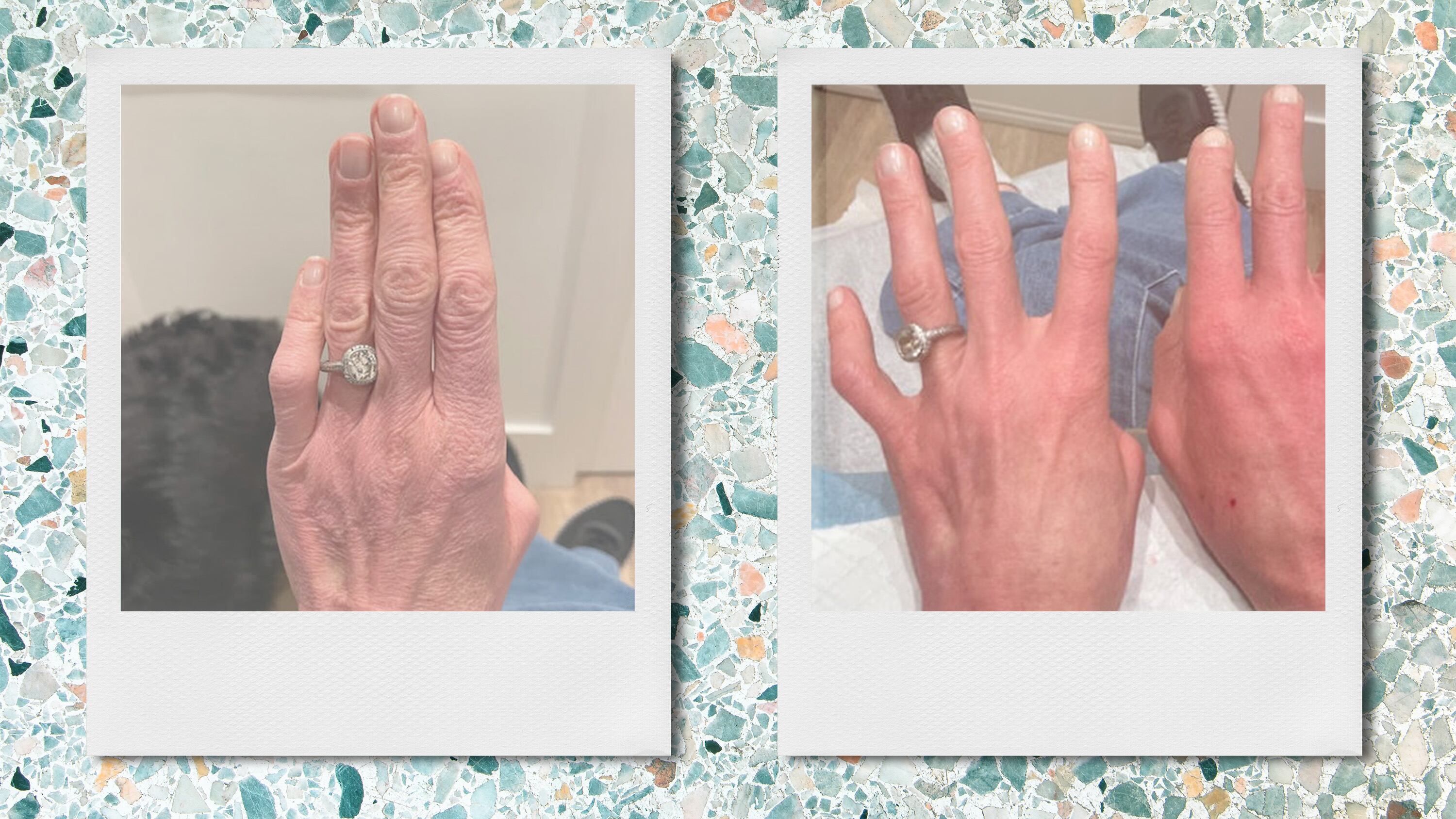This Treatment Made My Hands Look 20 Years Younger in One Appointment