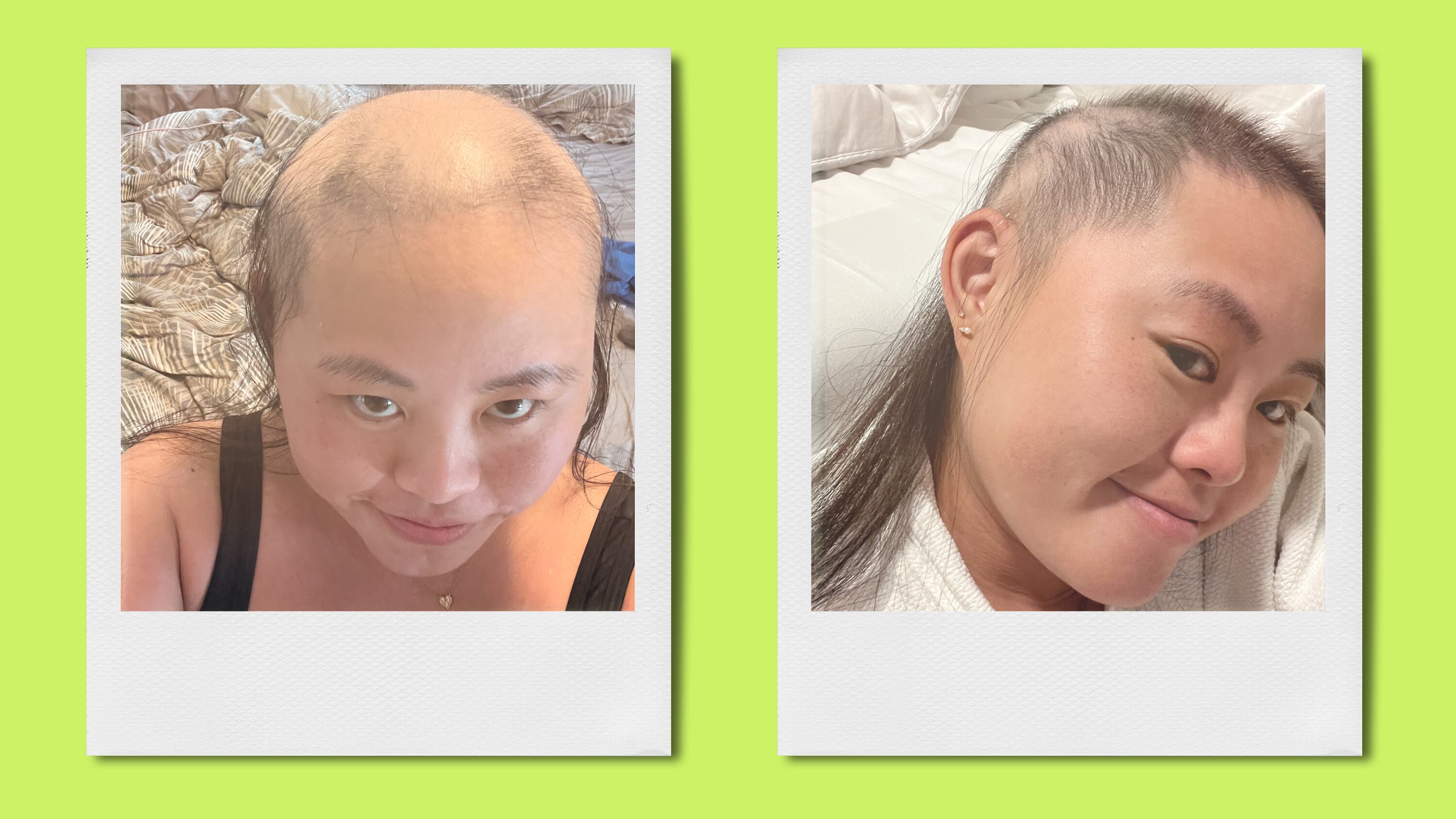 18 Million People Watched My Hair Grow Back After I Went Bald