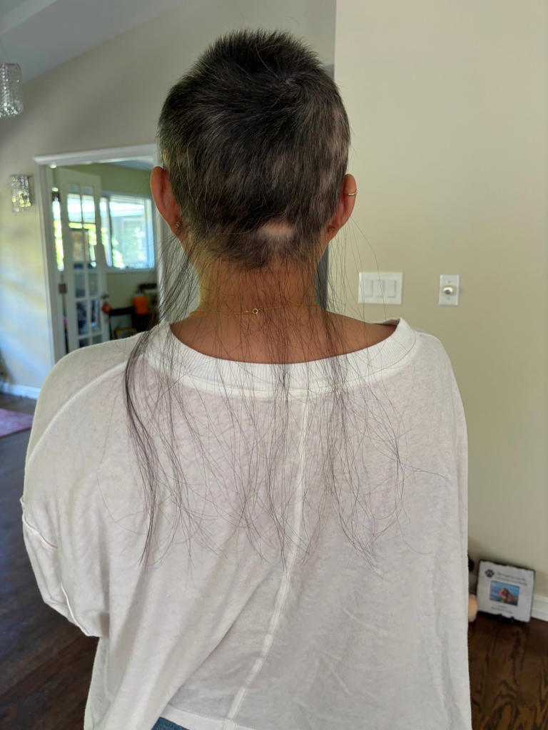 18 Million People Watched My Hair Grow Back After I Went Bald