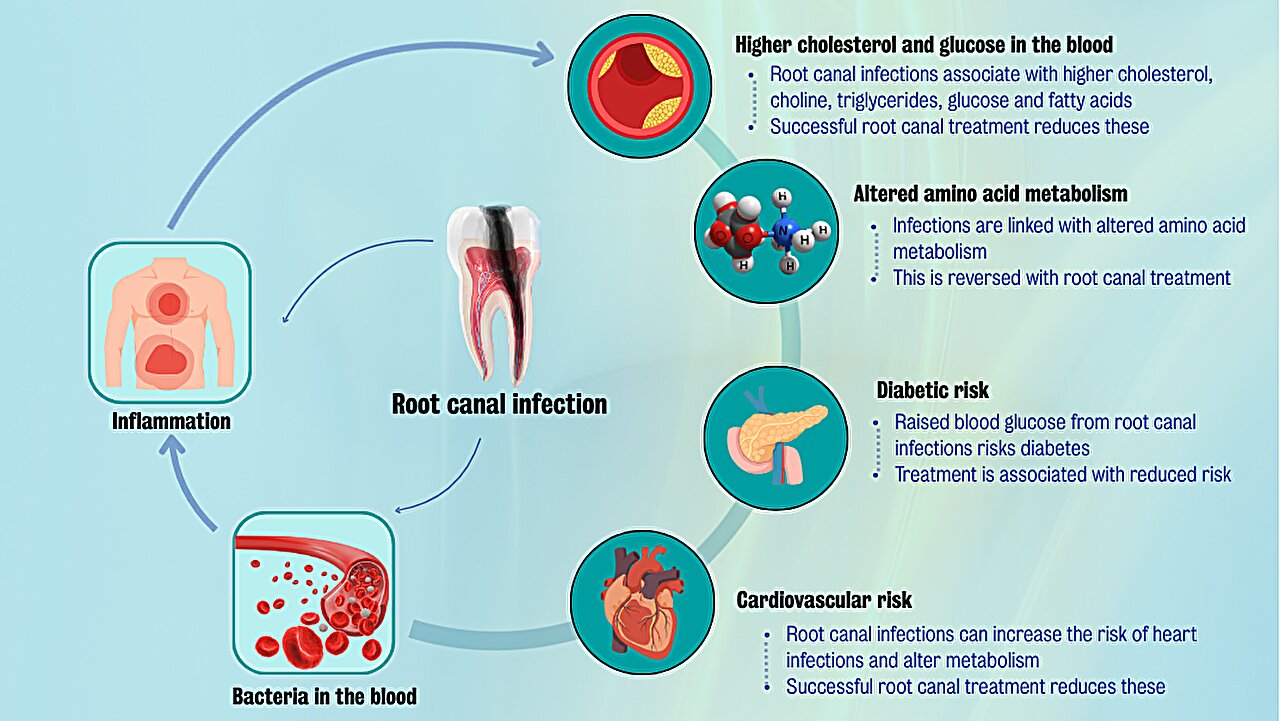 Root canal treatment may reduce heart disease and diabetes risk