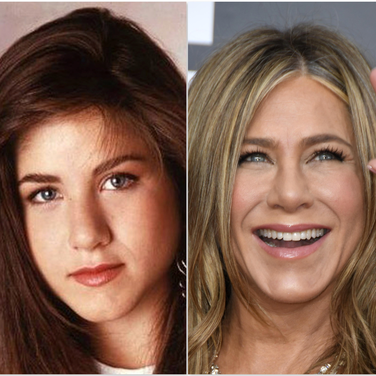 Baby Botox o microbotox: chi dovrebbe farlo e quando