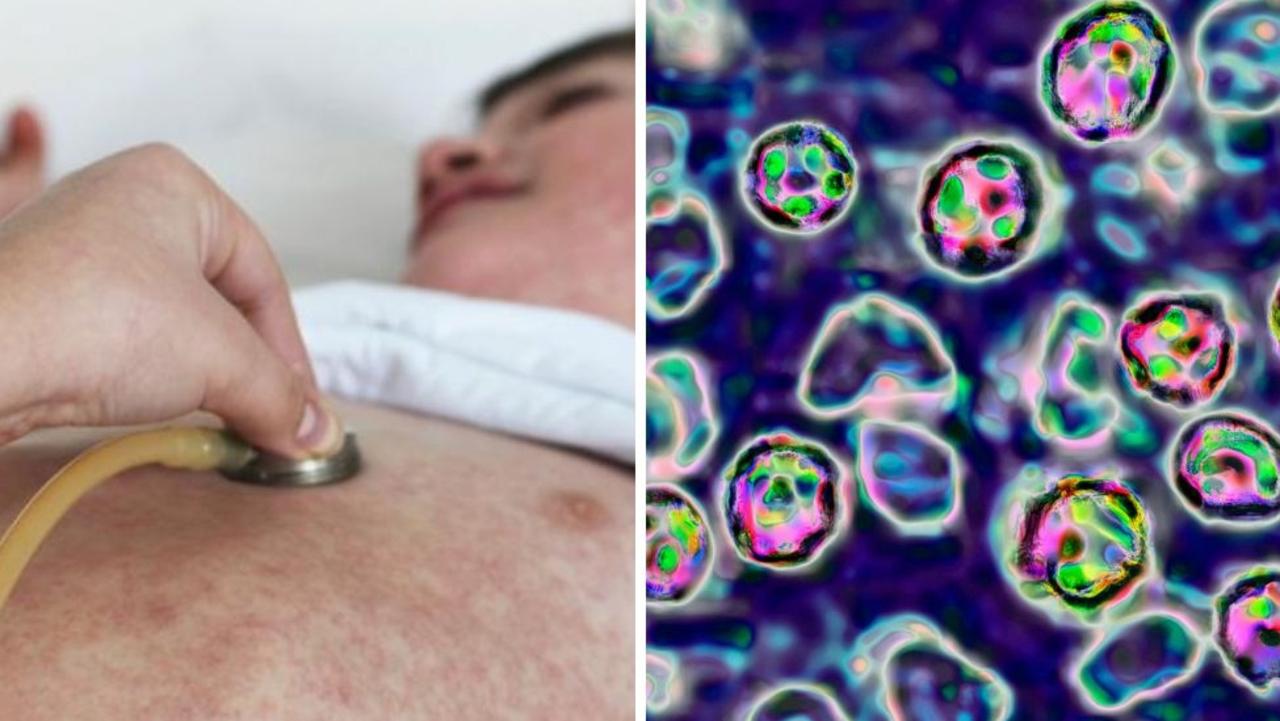 ‘High alert’: Measles outbreak spreads