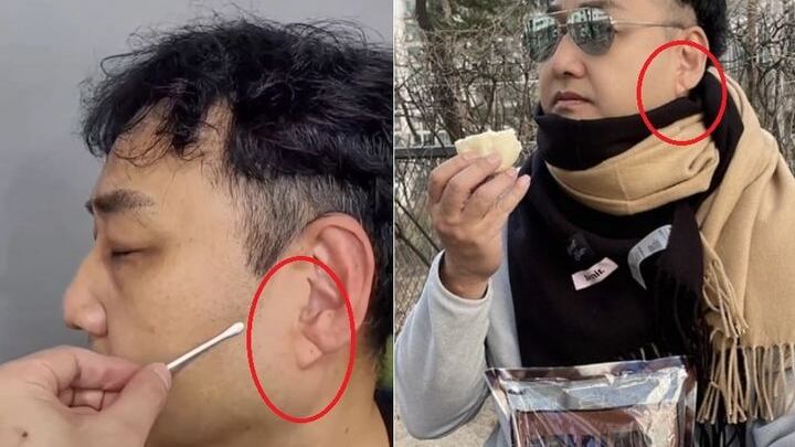 Earlobe crease, baldness signal health risks