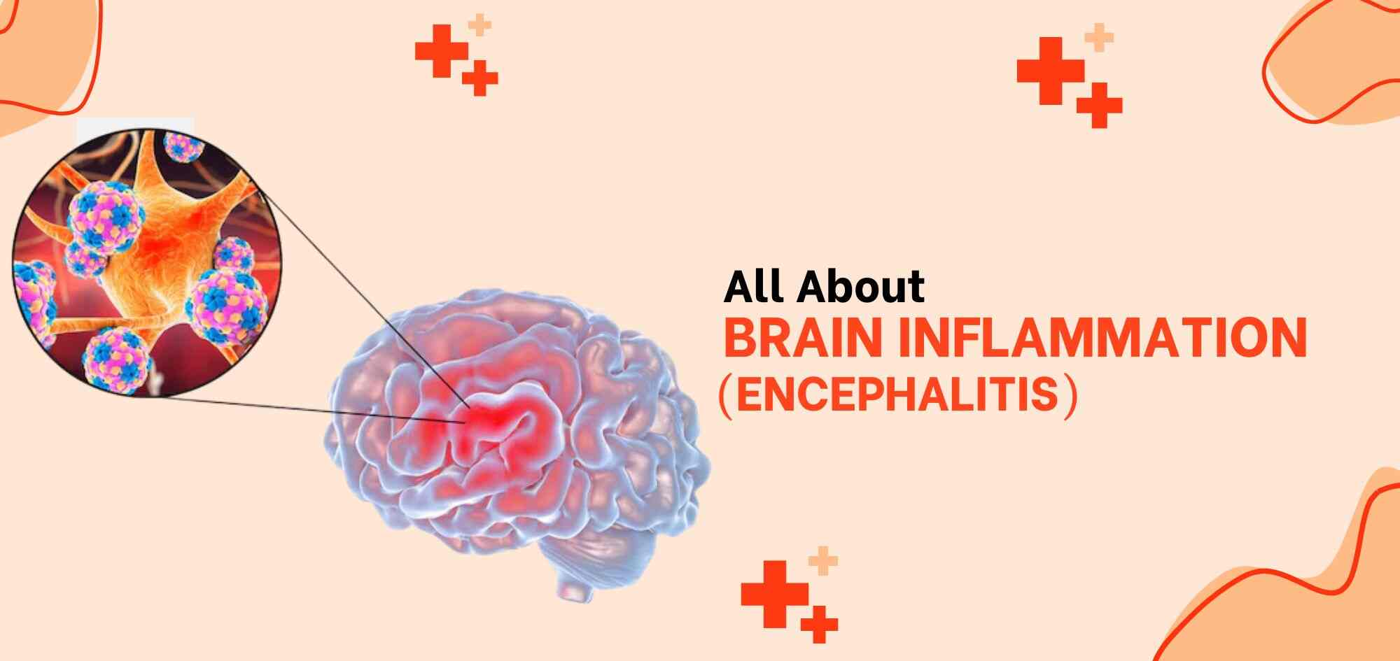 Brain Disease Encephalitis: The Silent Inflammation That Can Change ...